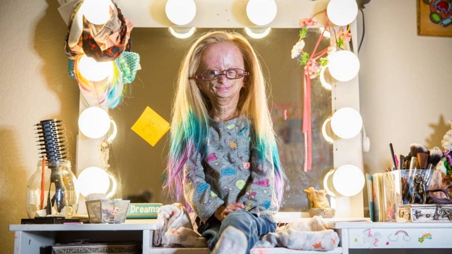 YouTube Star With Progeria Syndrome Passes Away at 15 | TIMCAST